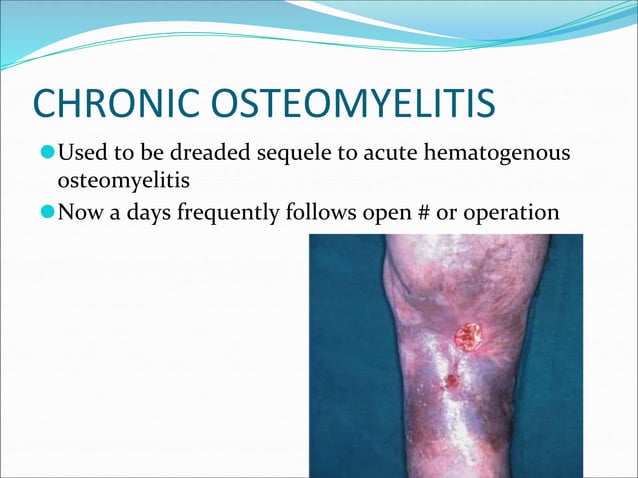Chronic osteomyelitis | PPT