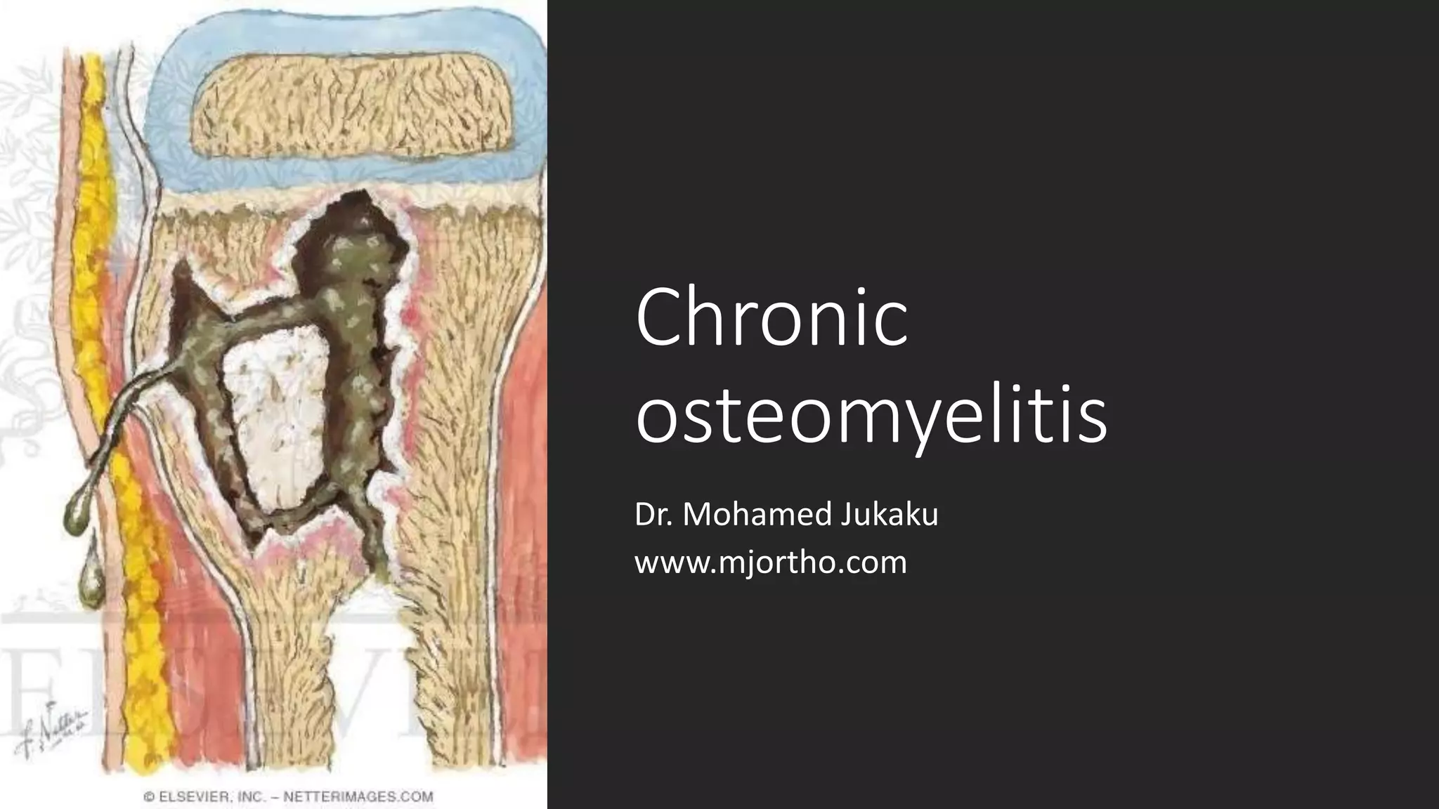 Chronic osteomyelitis | PPT
