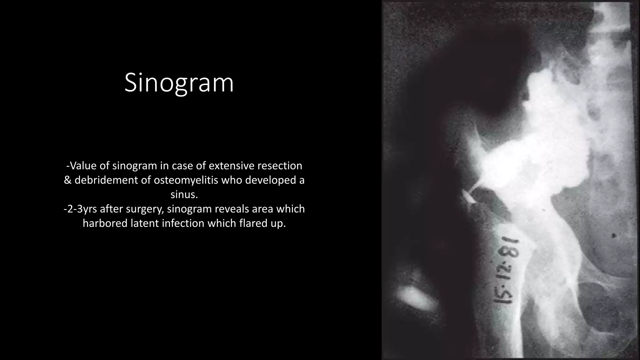 Chronic osteomyelitis | PPT