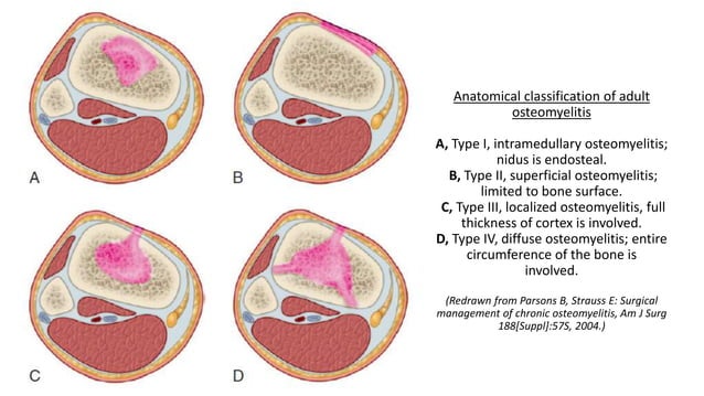 Chronic osteomyelitis | PPT