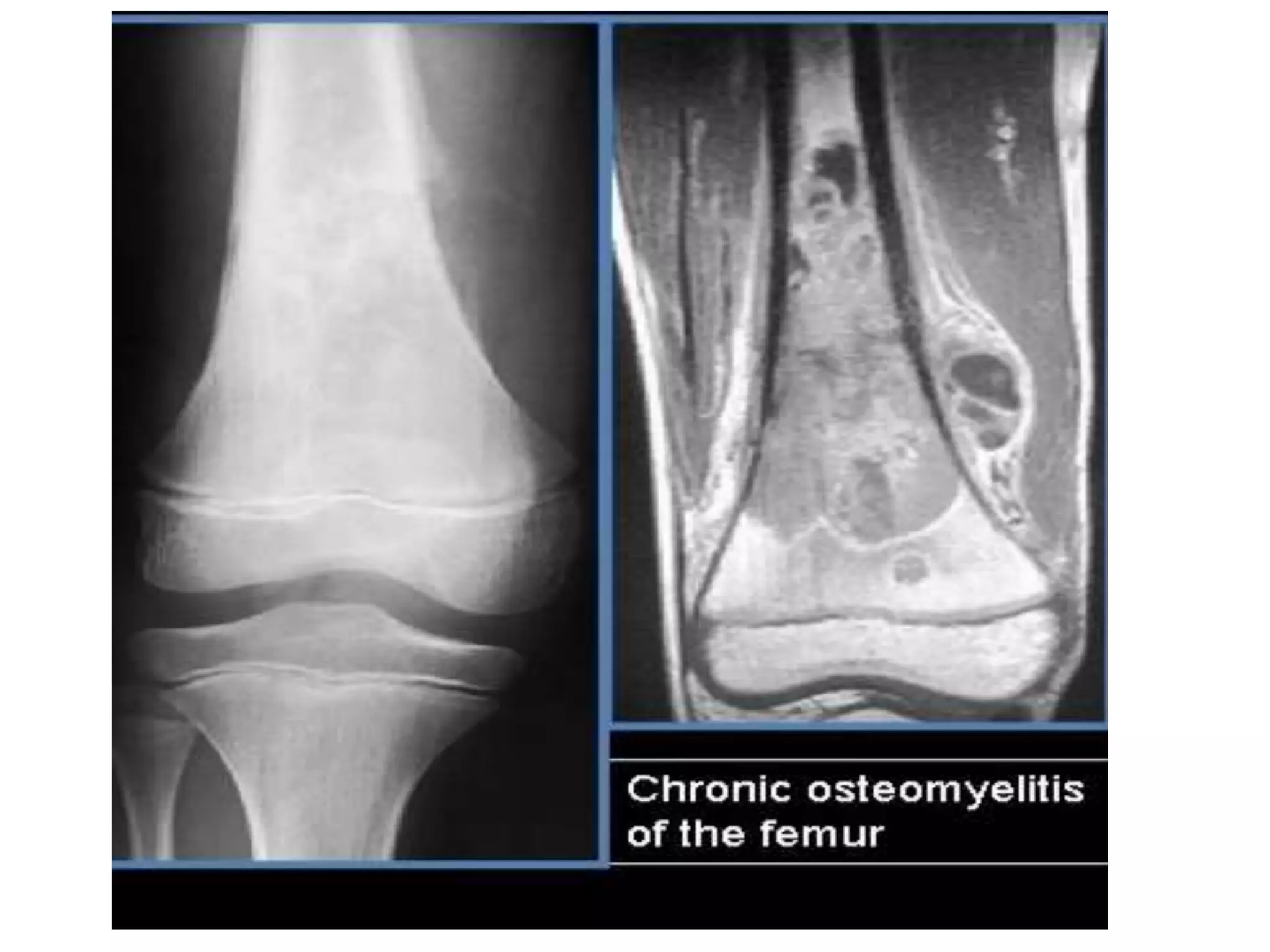 chronic osteomyelitis.pptx