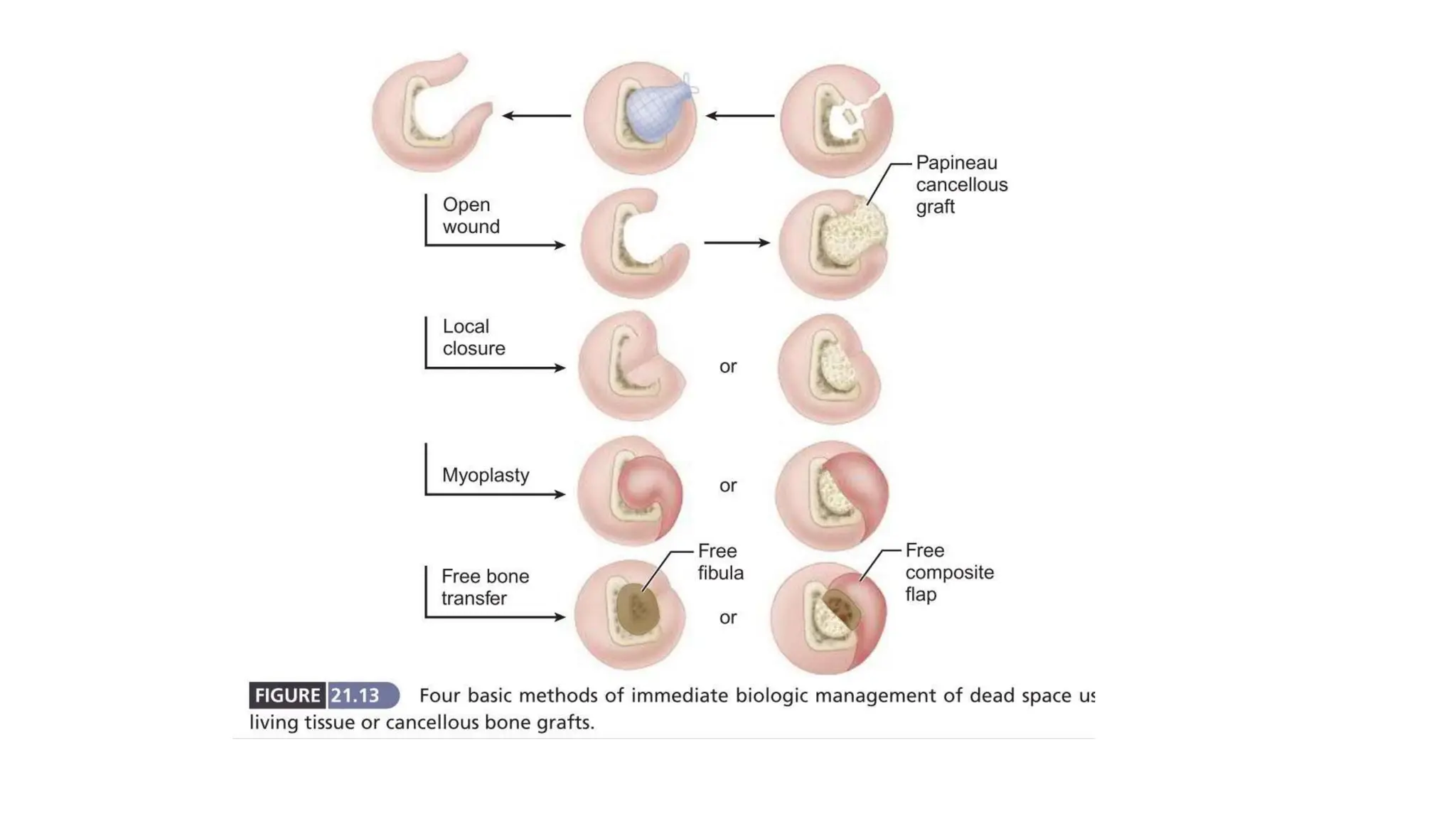 Chronic Osteomyelitis of bone and marrow cavity.pptx