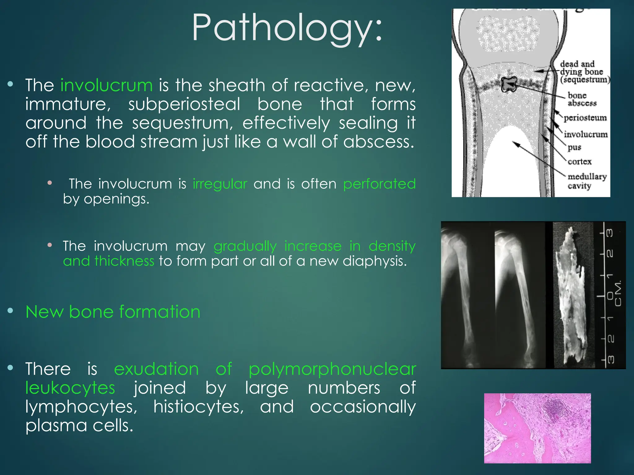 chronic osteomyelitis both acute and chronic | PPTX