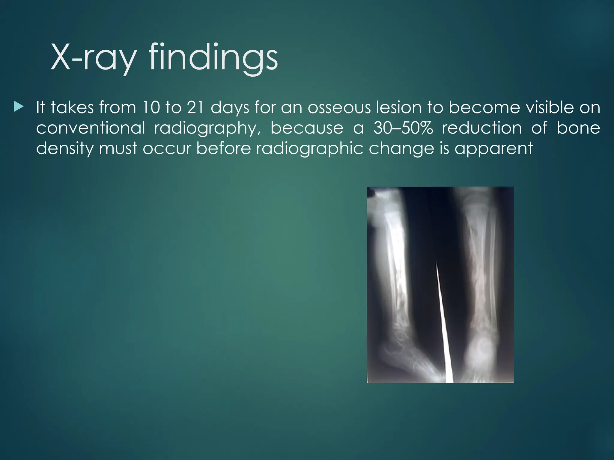 chronic osteomyelitis both acute and chronic | PPTX