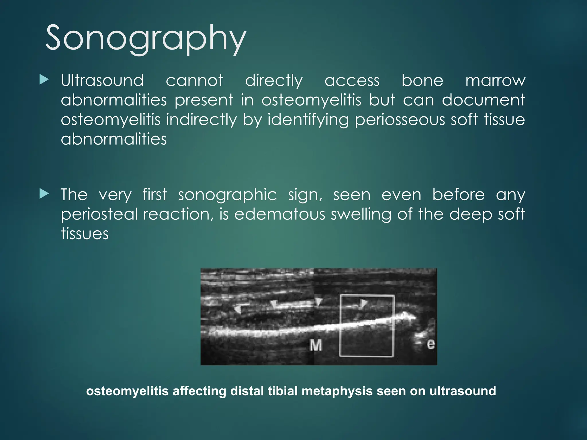 chronic osteomyelitis both acute and chronic | PPTX