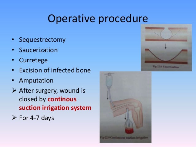 Chronic osteomyelitis2