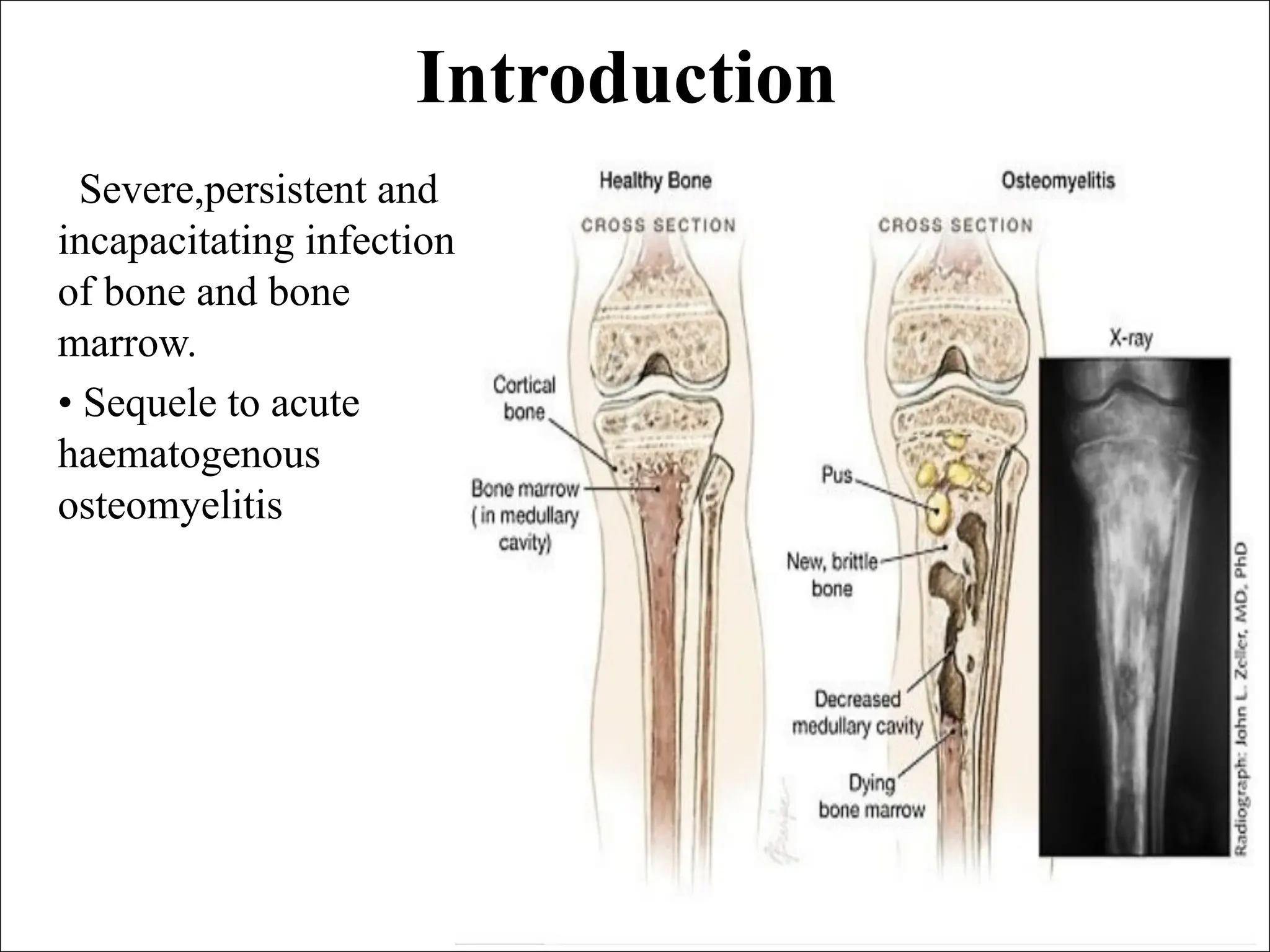 Chronic osteomy lllhhhhhhhhhhhhhhhhelitis (2).pdf
