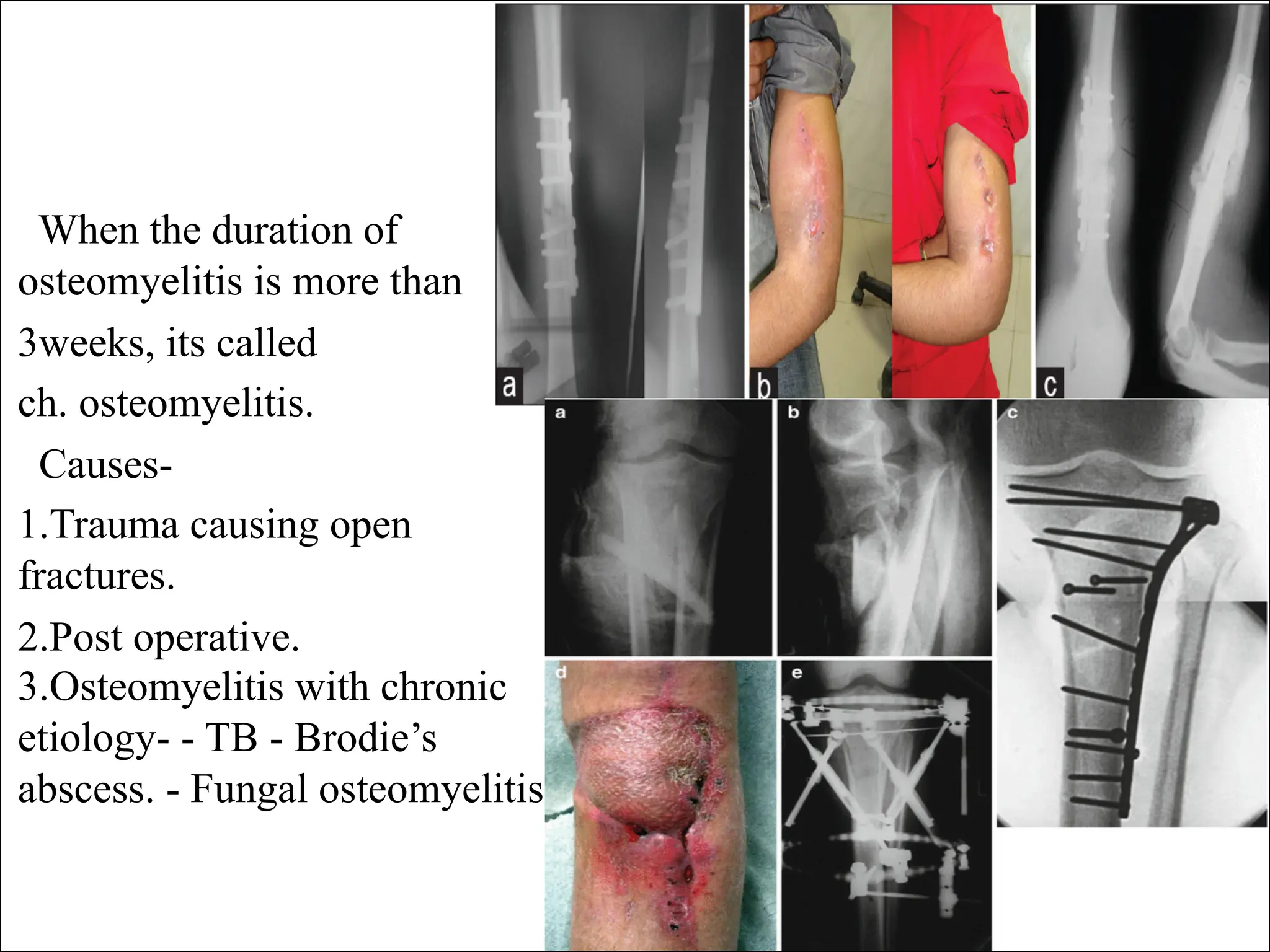 Chronic osteomy lllhhhhhhhhhhhhhhhhelitis (2).pdf