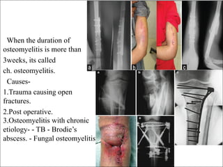 Chronic osteomy lllhhhhhhhhhhhhhhhhelitis (2).pdf