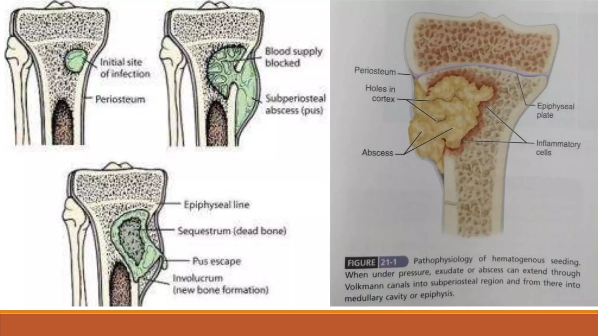 Chronic osteomyelitis seminar and case report ortho patho | PPTX