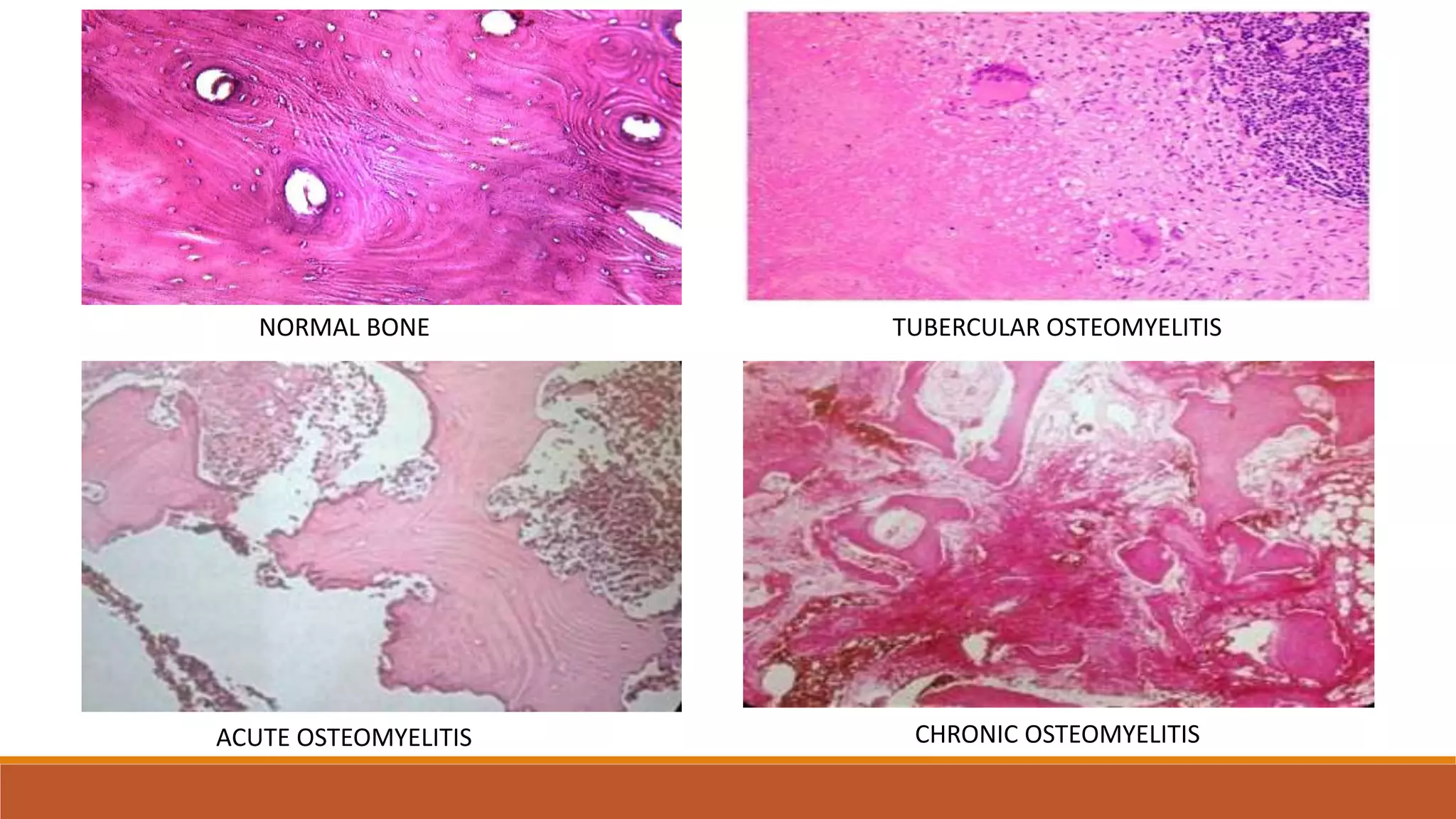 Chronic osteomyelitis seminar and case report ortho patho | PPTX