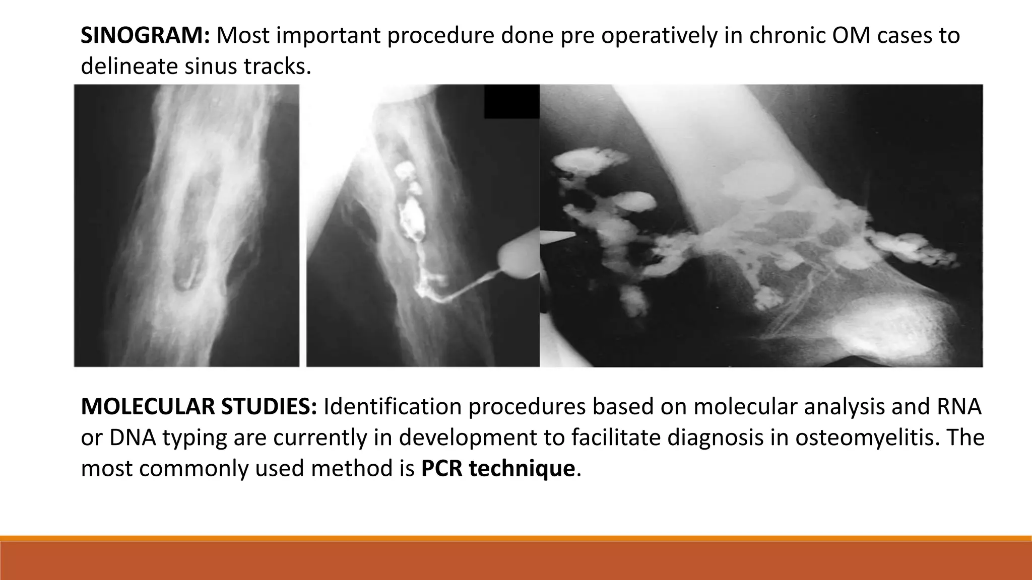 Chronic osteomyelitis seminar and case report ortho patho | PPTX