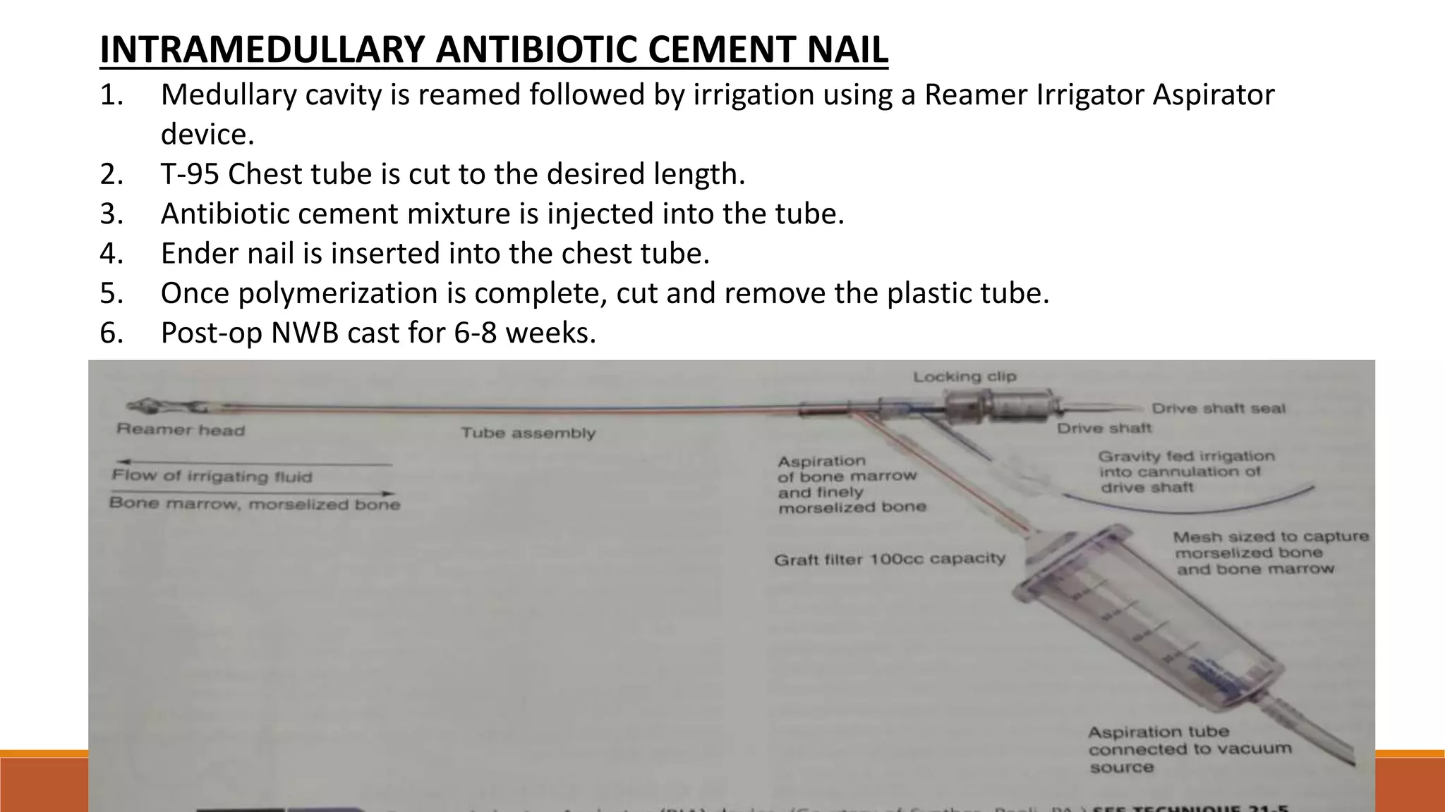 Chronic osteomyelitis seminar and case report ortho patho | PPTX