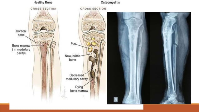 Chronic osteomyelitis seminar and case report ortho patho | PPTX | Bone ...