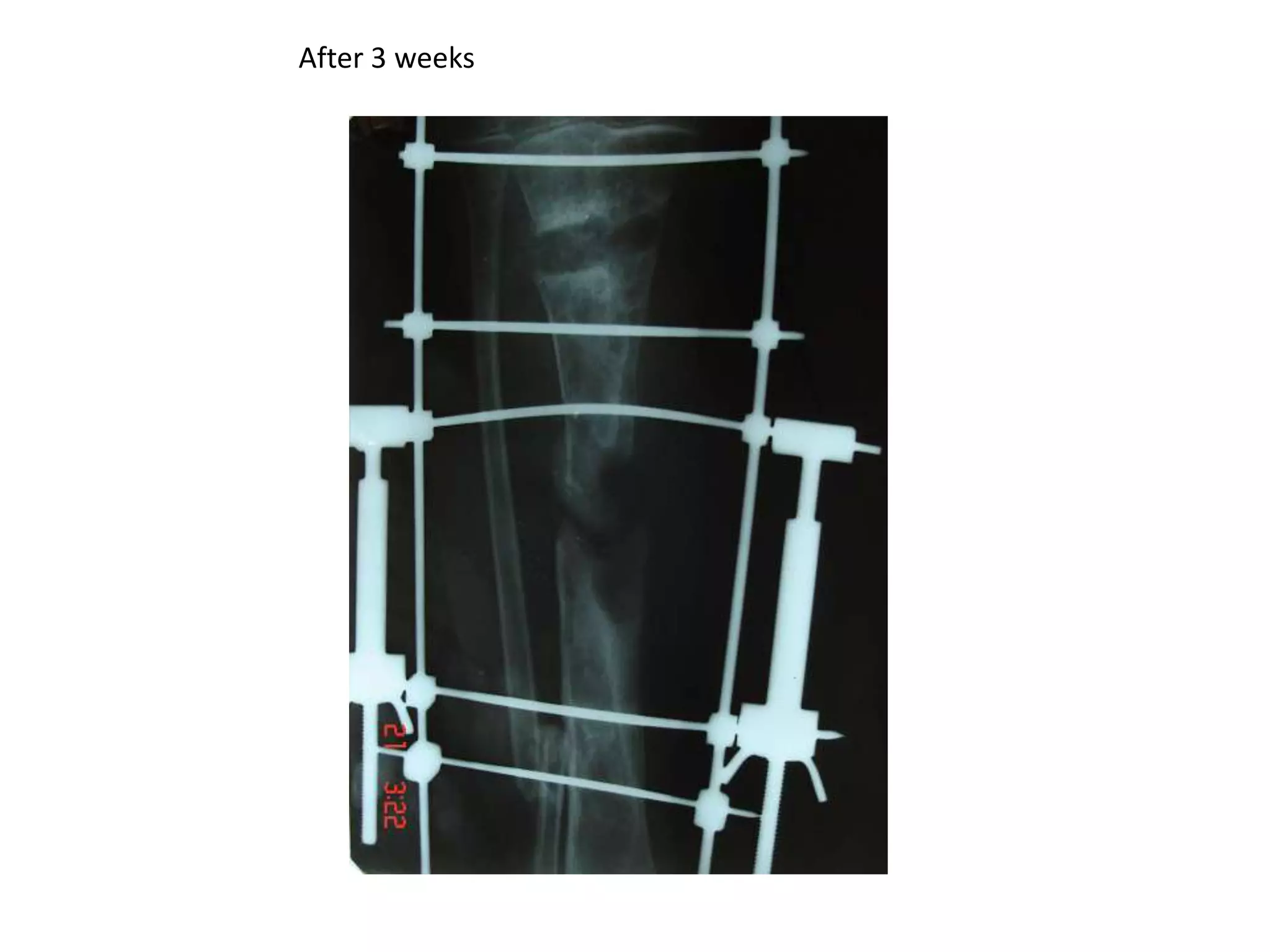 Chronic osteomylitis of tibia with infected gap non union treated by ...