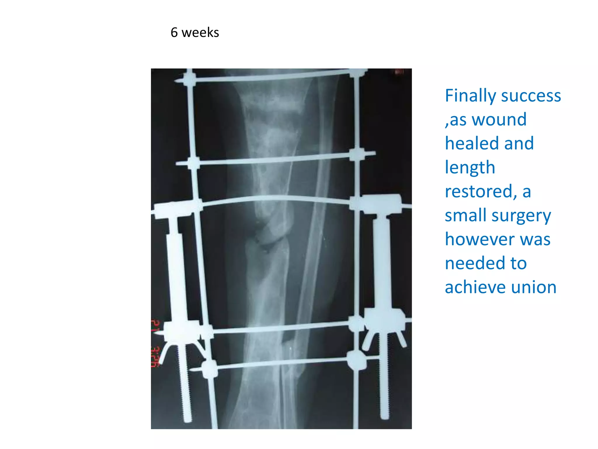 Chronic osteomylitis of tibia with infected gap non union treated by ...