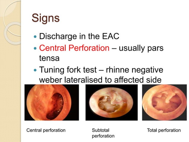 Chronic otitis media | PPTX | Ear, Nose and Throat Conditions ...