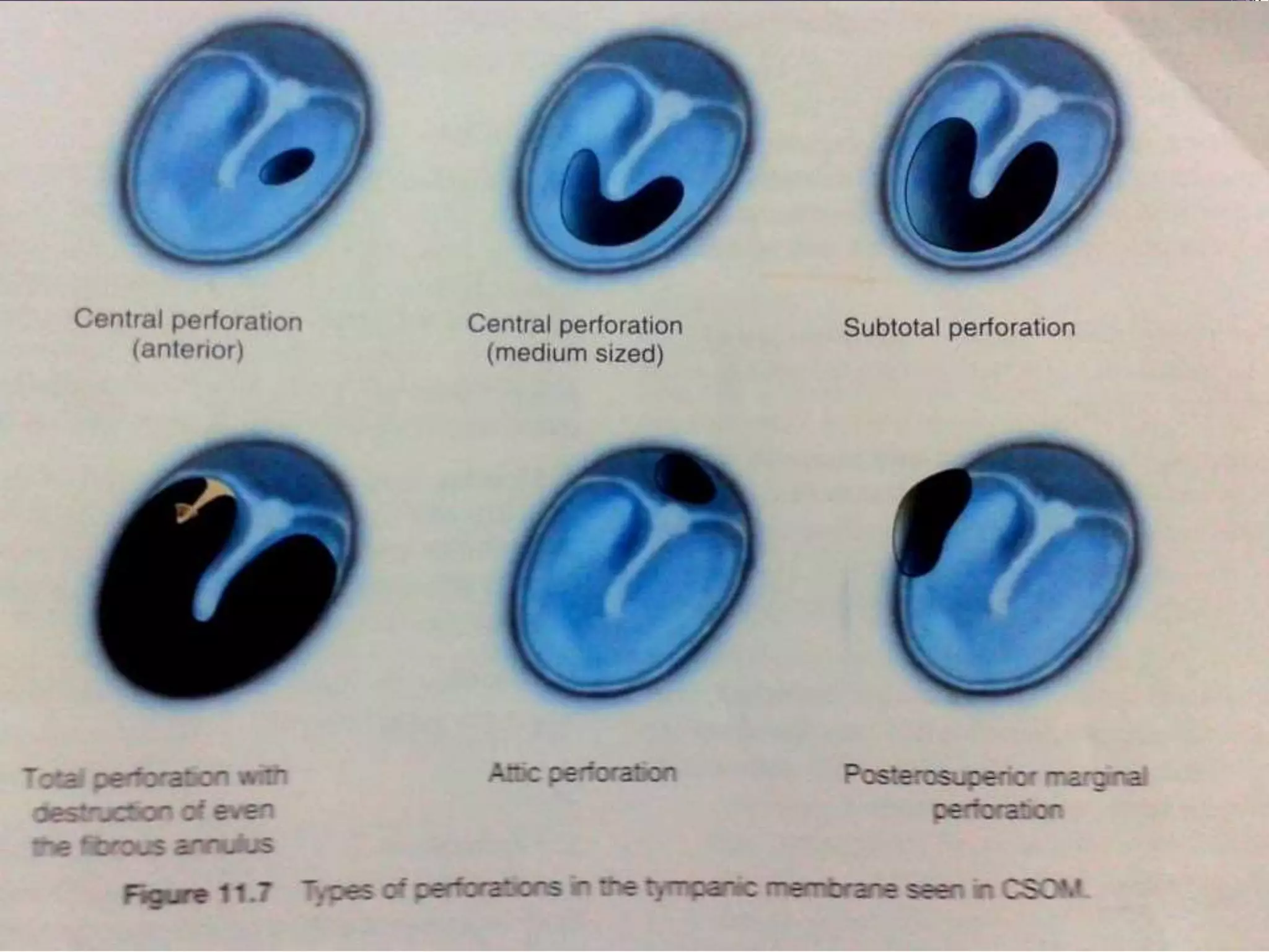 Chronic Otitis Media | PPTX