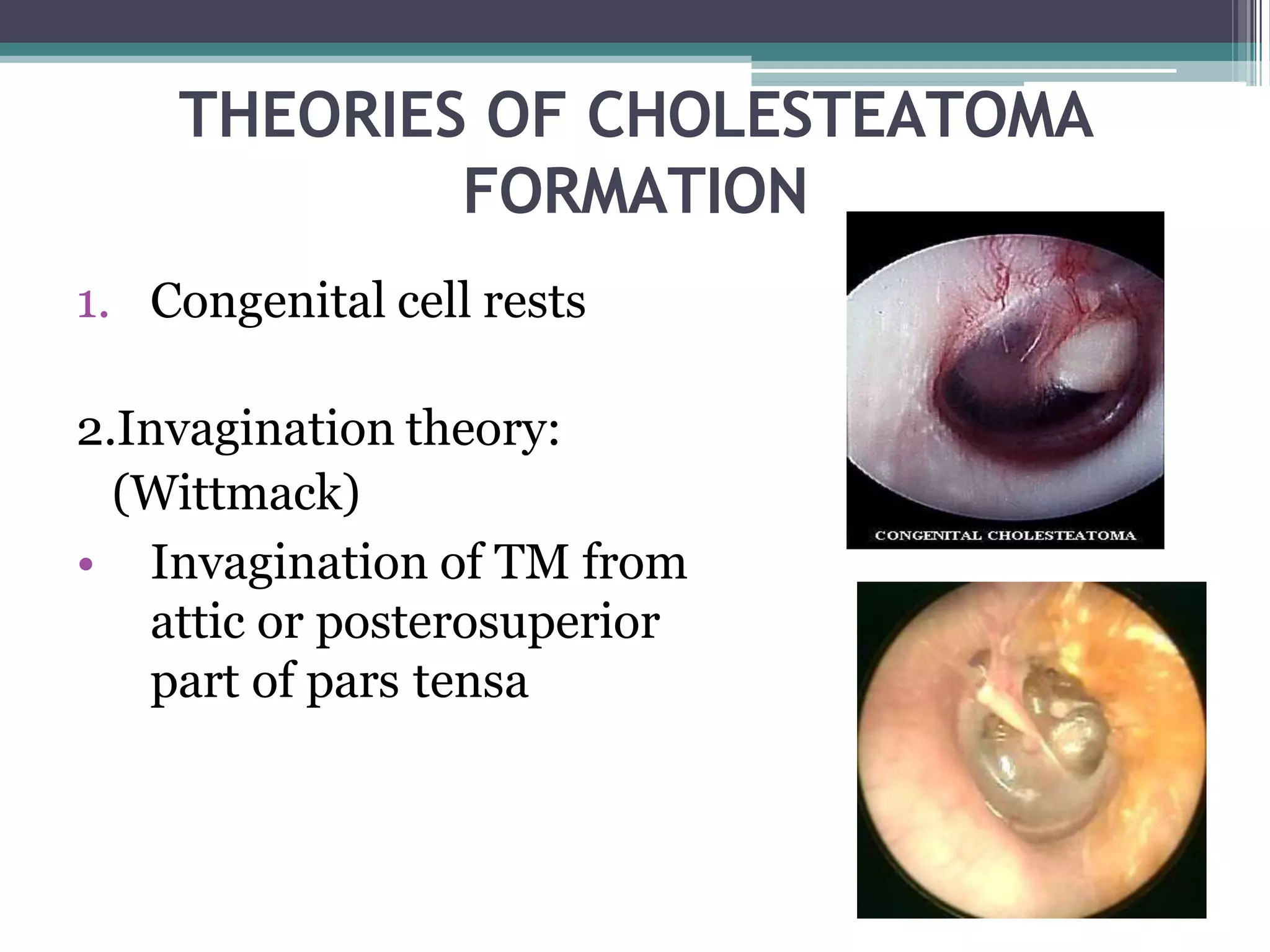 Chronic Otitis Media | PPTX
