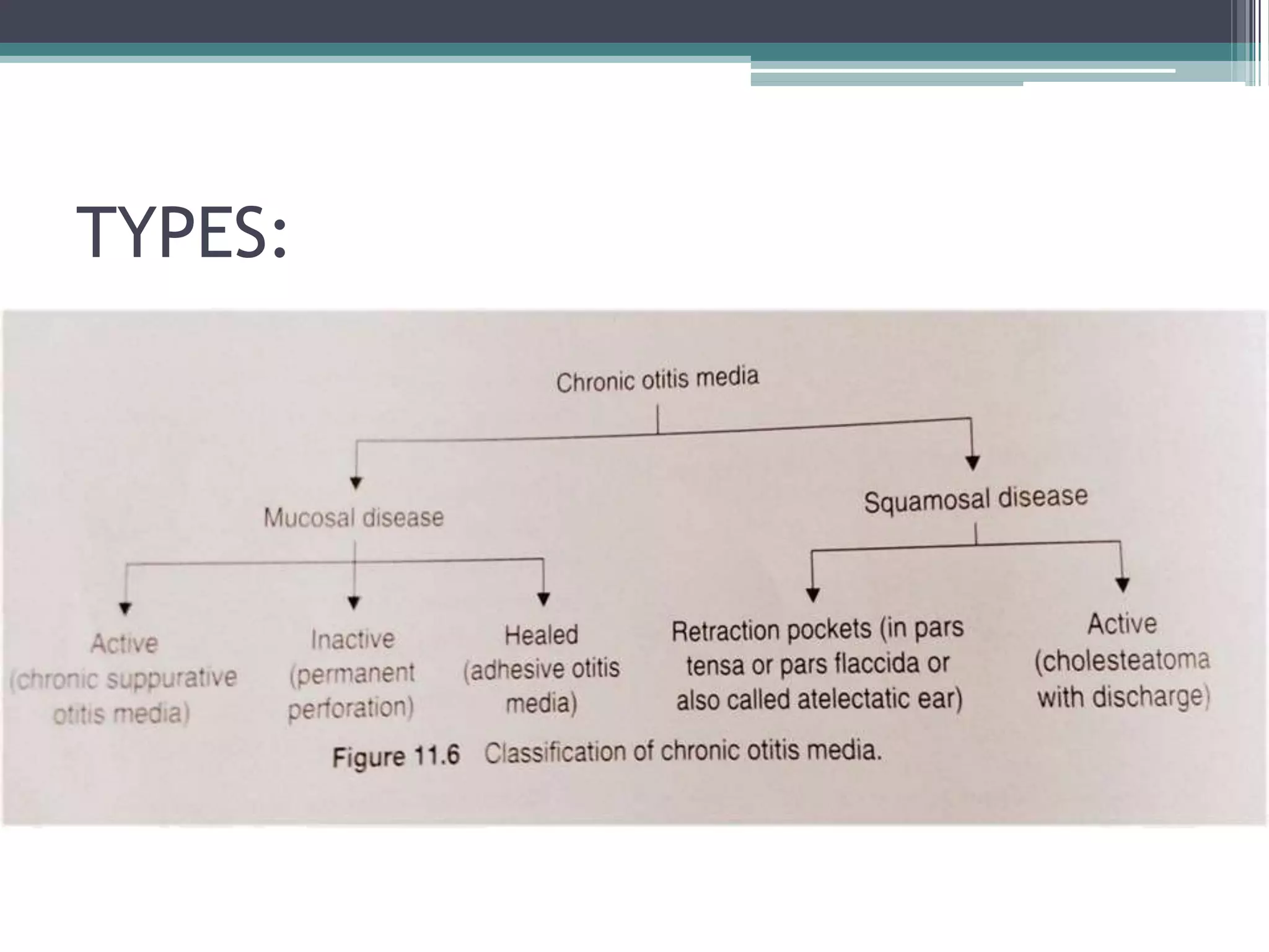 Chronic Otitis Media | PPTX