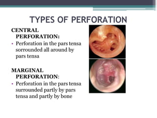 Chronic Otitis Media | PPT