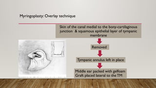 Chronic otitis media- Mucosal chronic chronic media idk | PPTX