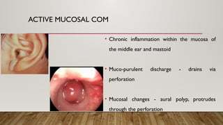 Chronic otitis media- Mucosal chronic chronic media idk | PPTX