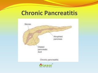 Chronic pancreatitis | PPTX