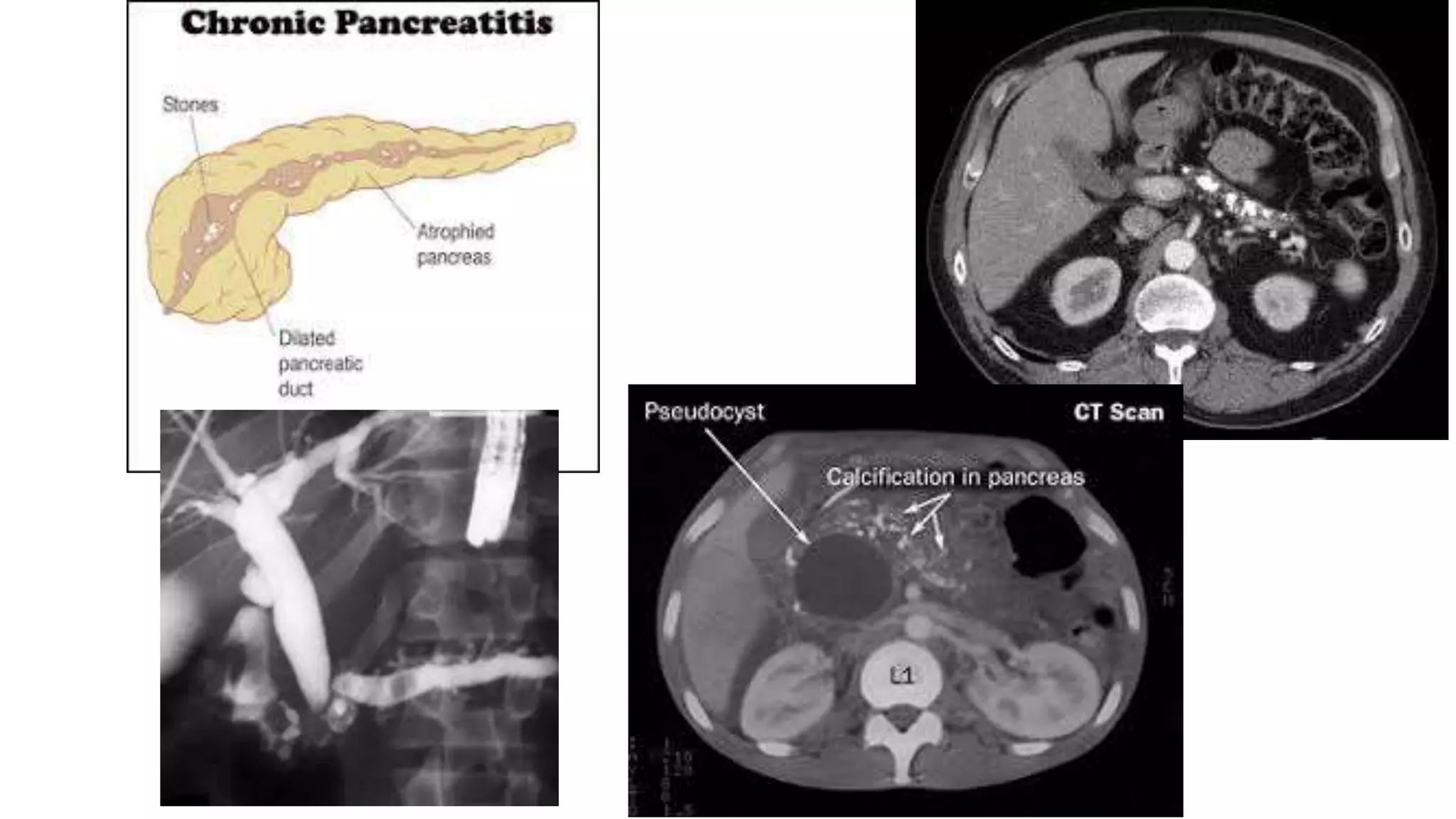Chronic pancreatitis | PPTX | Digestive Disorders | Diseases and Conditions