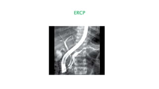 Chronic pancreatitis | PPTX