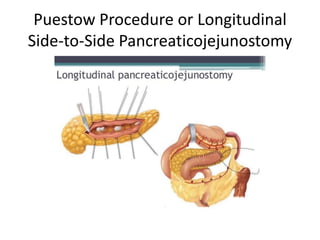 Chronic Pancreatitis: Dr Dhaval Mangukiya | PPT