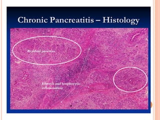 Chronic pancreatitis | PPTX