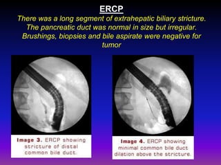 chronic pancreatitis.ppt