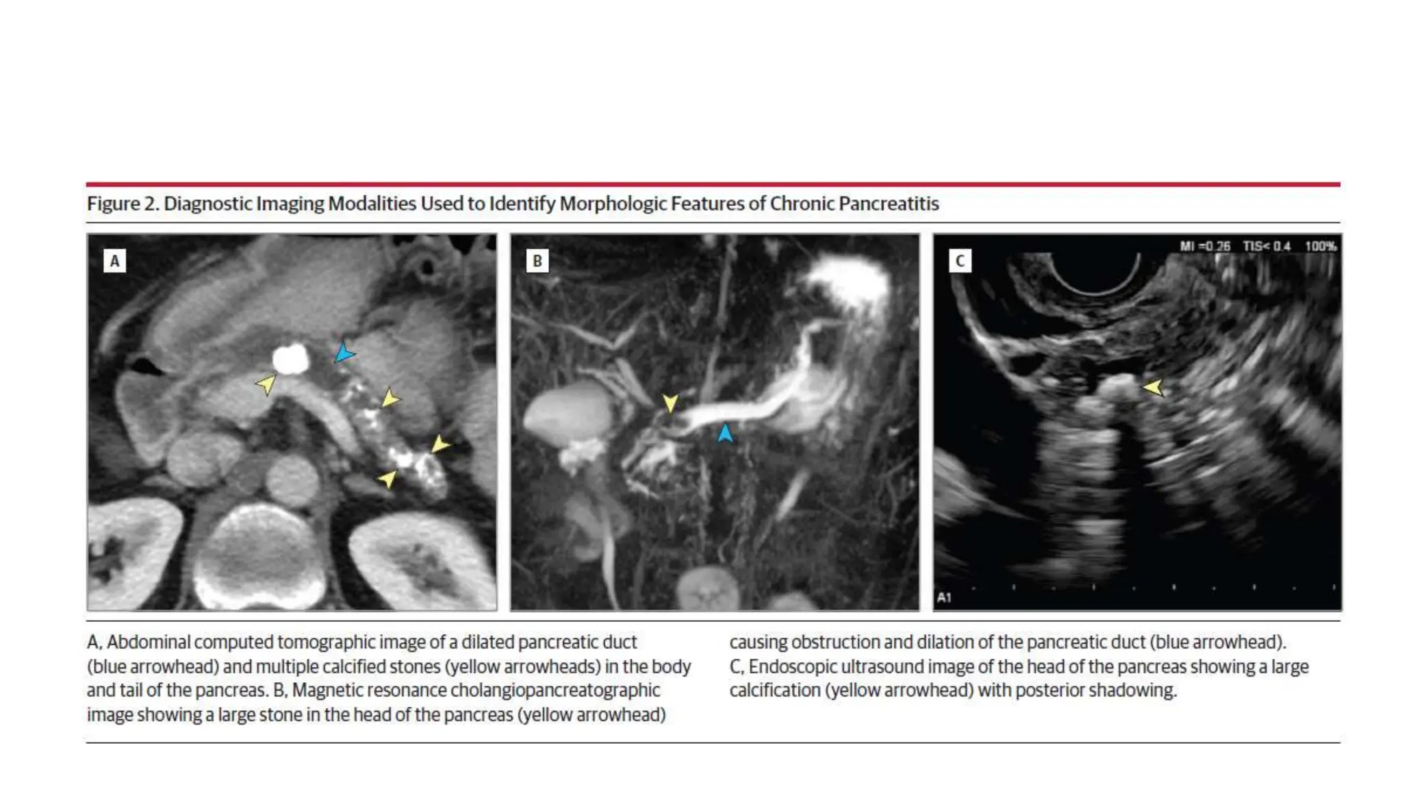 Diagnosis and management of Chronic Pancreatitis.pptx