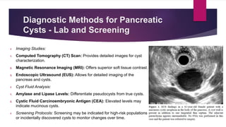Chronic Pancreatitis: Understanding Causes, Symptoms, Diagnosis, and ...