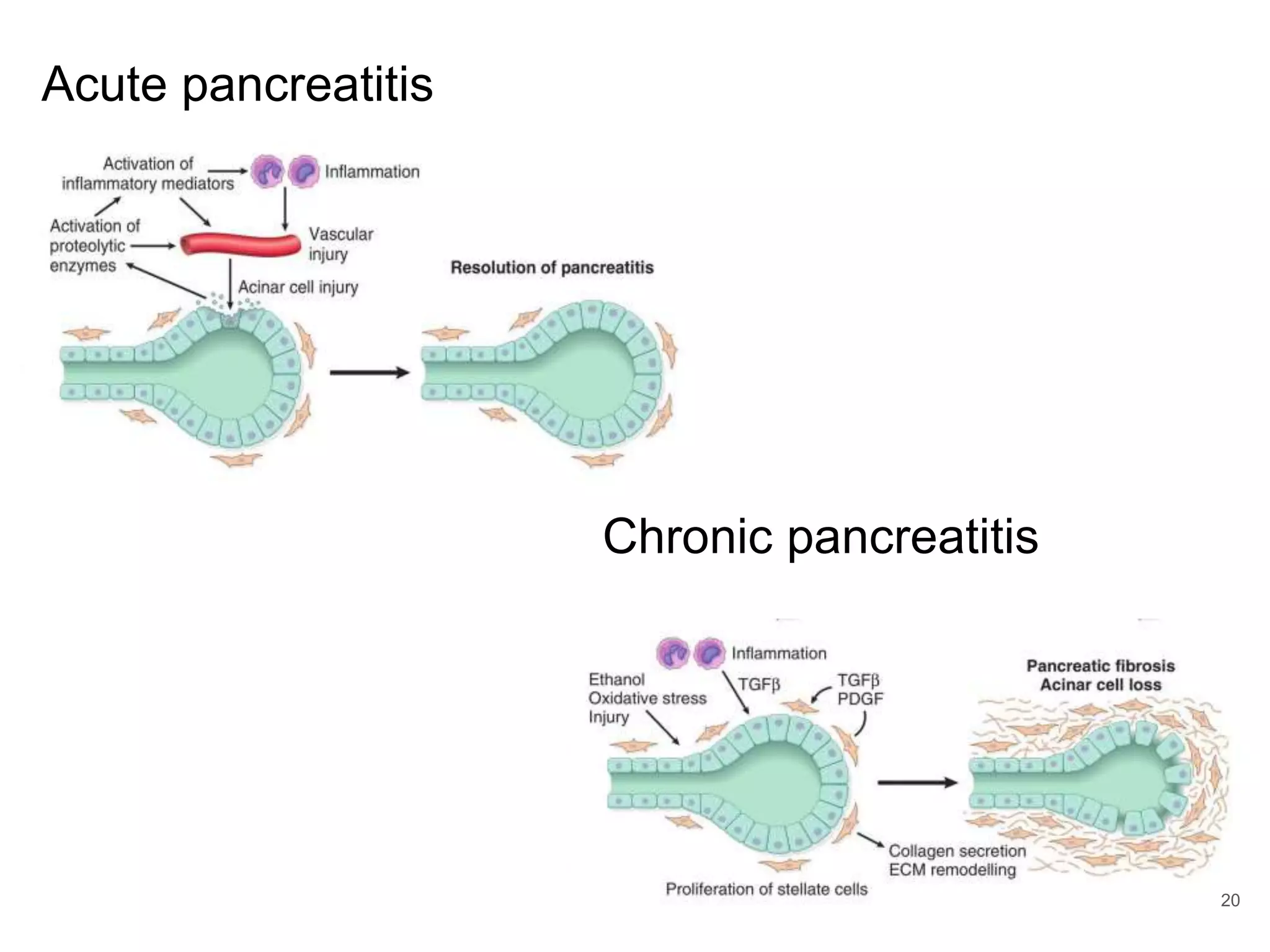 Chronic pancreatitis and its surgical management | PPTX | Endocrine and ...