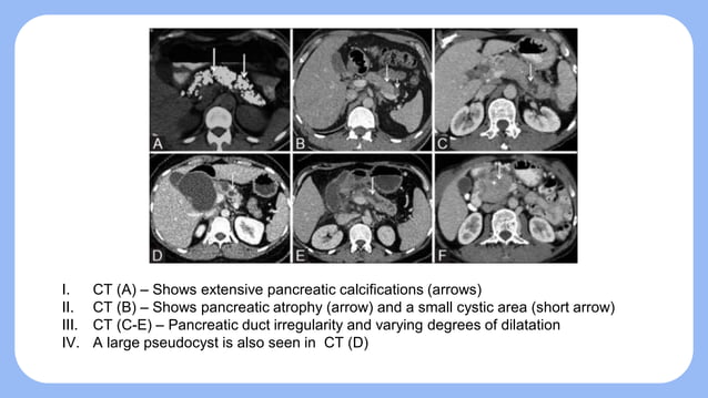 Chronic Pancreatitis (Lab and Instrumental Diagnosis).pptx