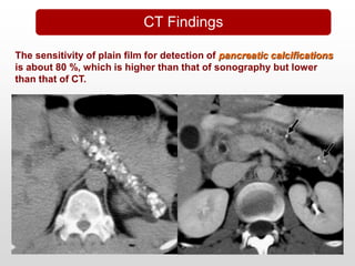 Chronic pancreatitis lecture | PPTX