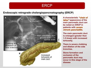 Chronic pancreatitis lecture | PPTX