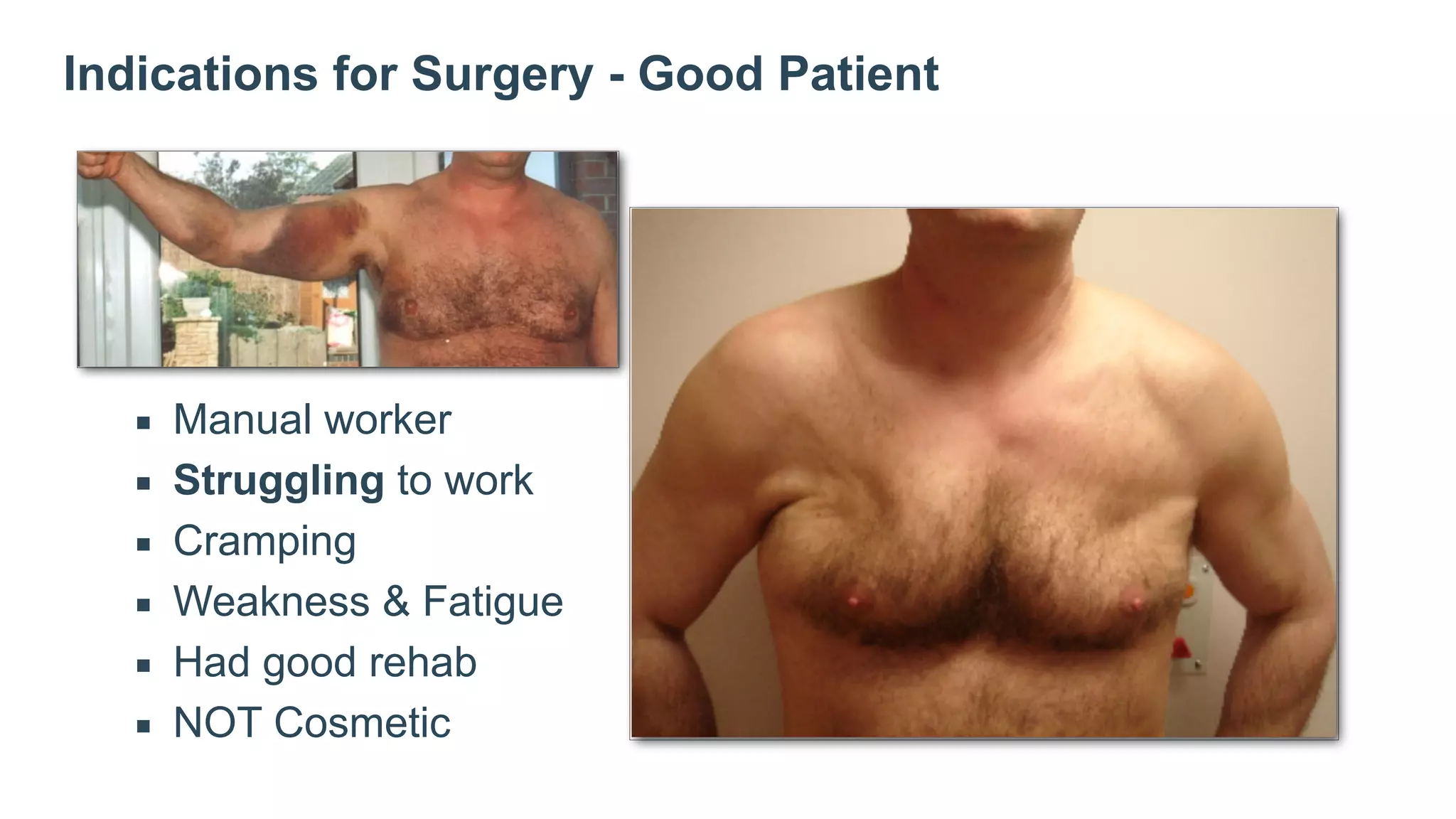 Chronic Pectoralis Major Injuries Len Funk 2020 | PPT