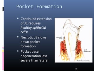 periodontitis | PPT