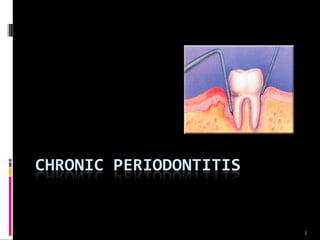 Chronic Periodontitis(Adult Periodontitis).ppt