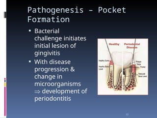 Chronic Periodontitis(Adult Periodontitis).ppt