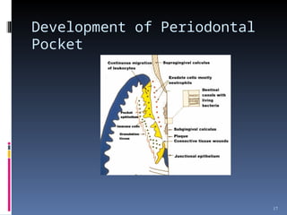 Chronic Periodontitis(Adult Periodontitis).ppt