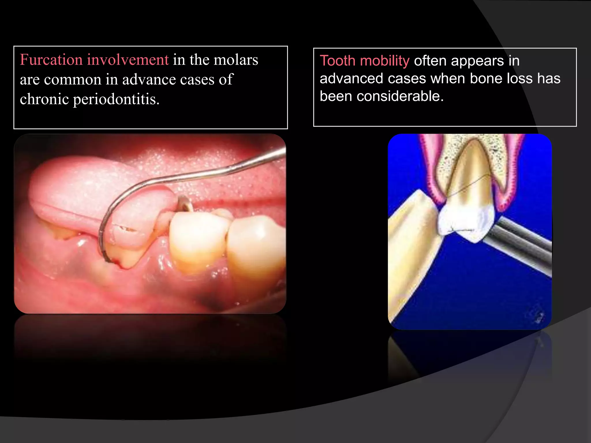 Chronic periodontitis | PPTX