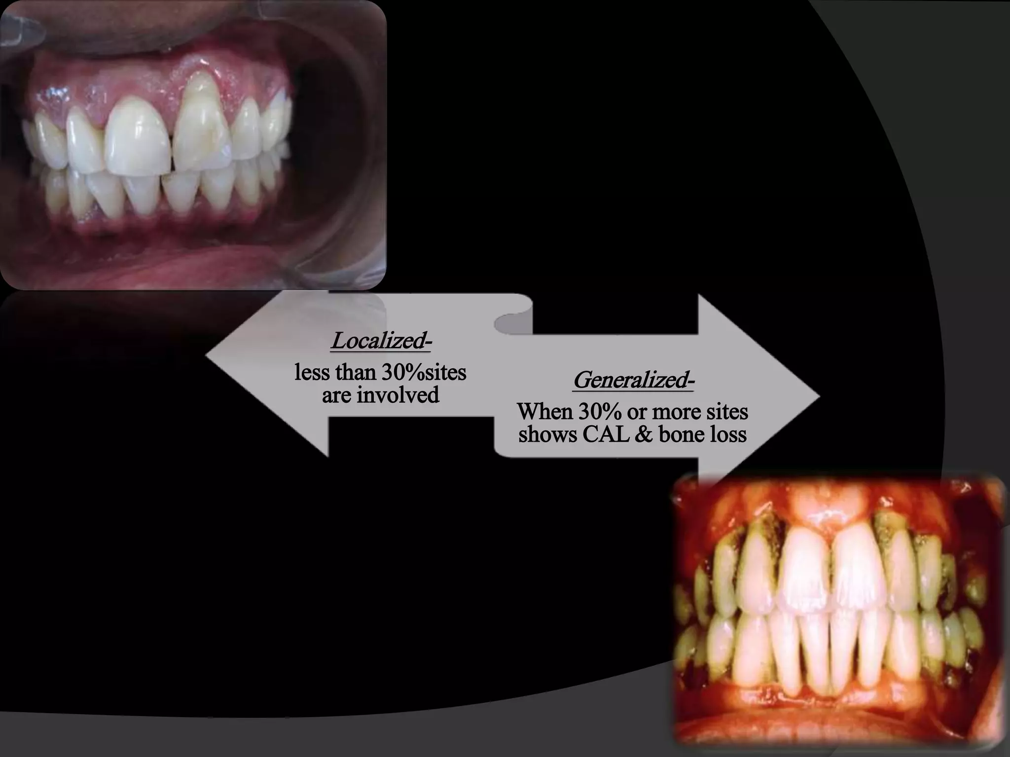Chronic periodontitis | PPTX