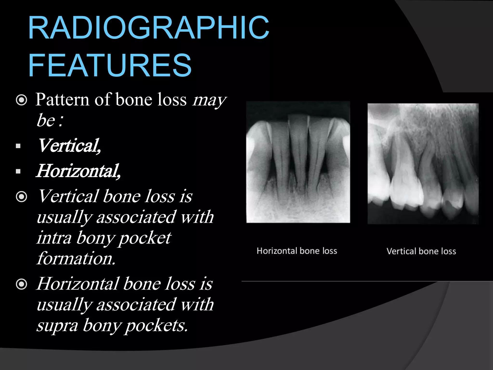 Chronic periodontitis | PPTX