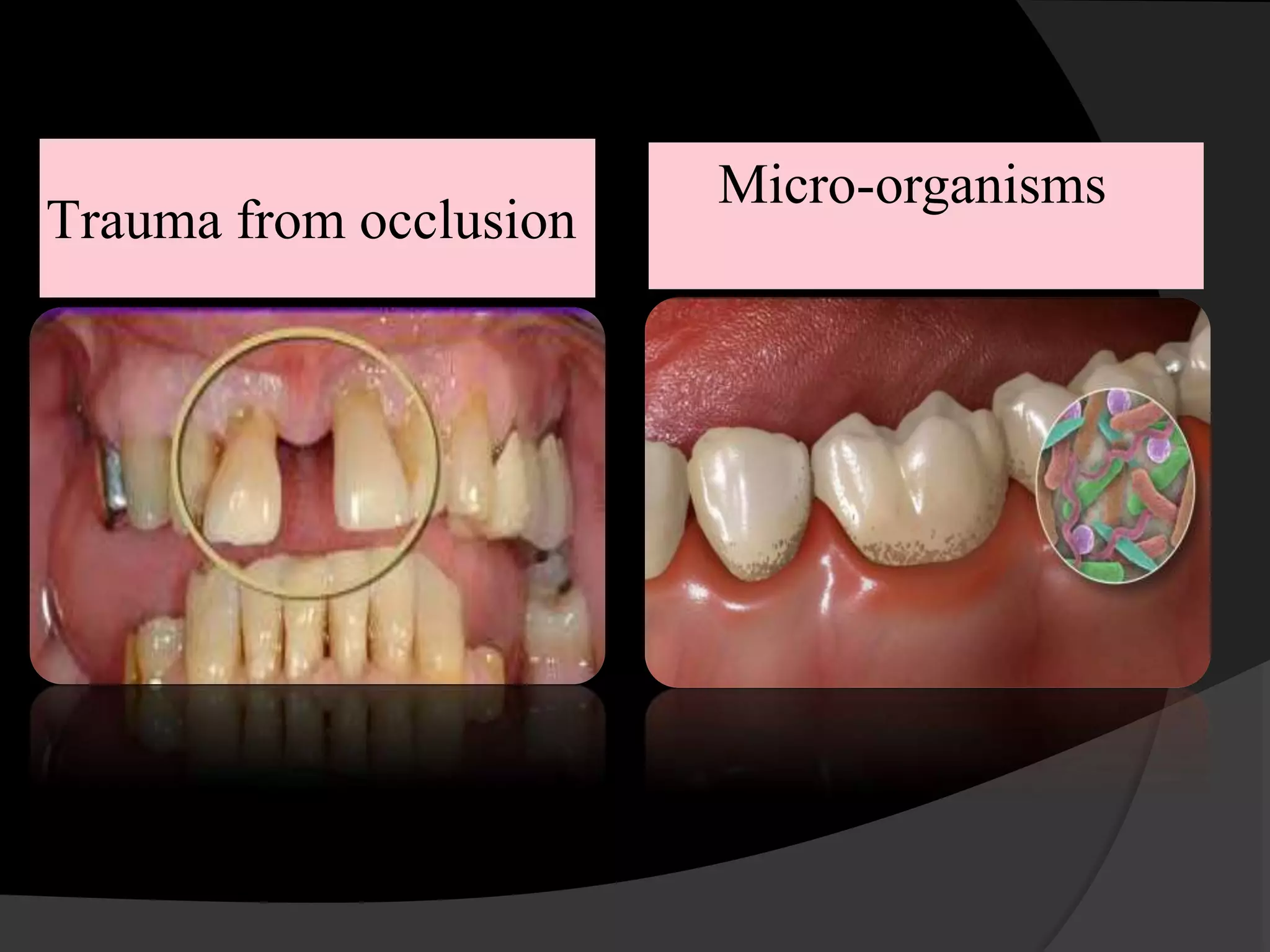 Chronic periodontitis | PPTX