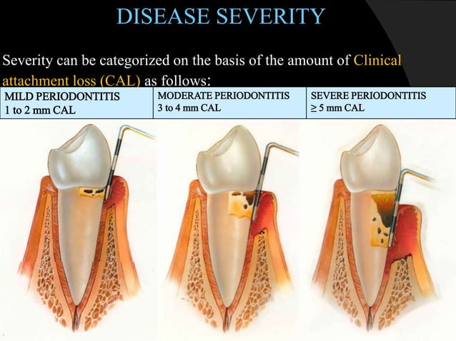 Chronic periodontitis | PPTX