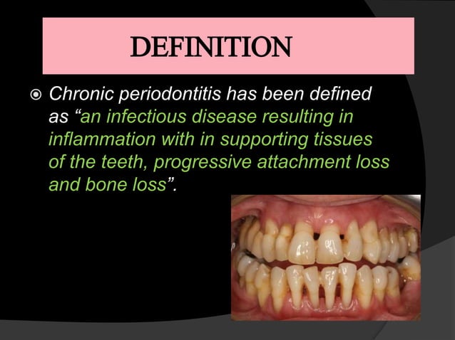 Chronic periodontitis | PPTX